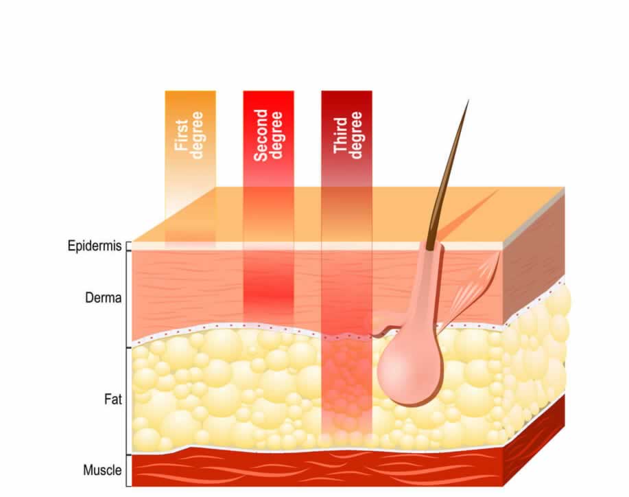 Classifications Of Burns