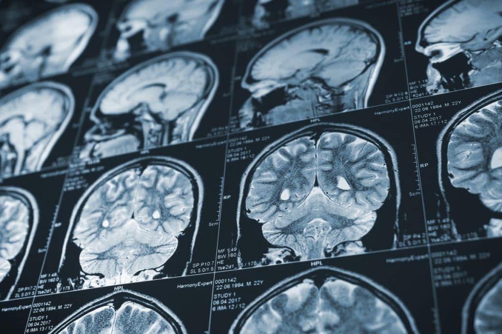 TBI vs. Concussion - What Are the Differences?