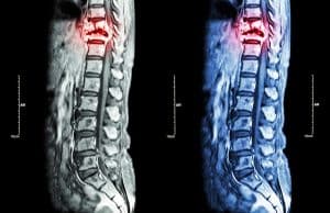 Complications Arising From Paralysis Due to Spinal Cord Injuries