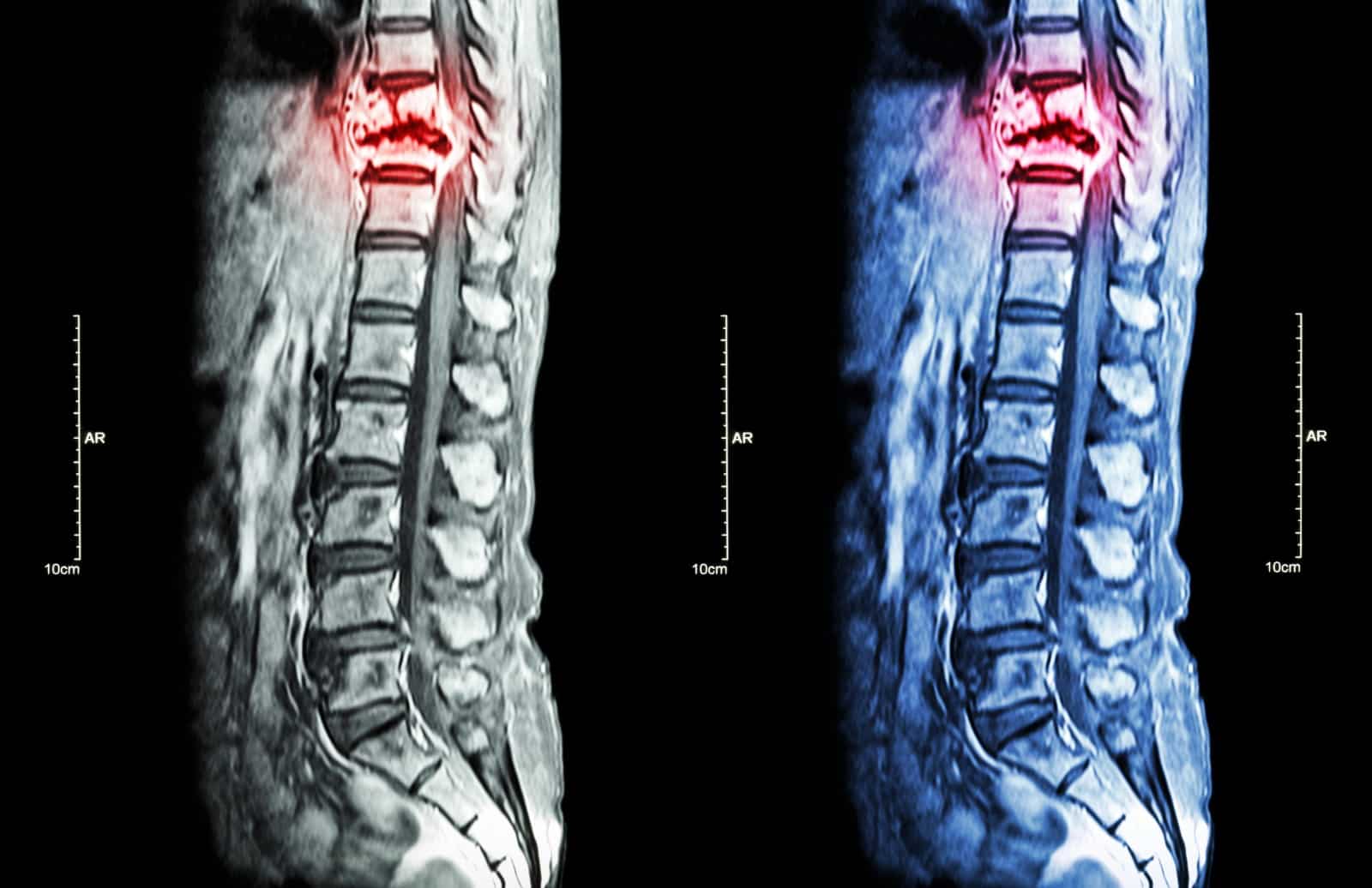 What Are the Four Types of Spinal Cord Injuries? - McNicholas ...