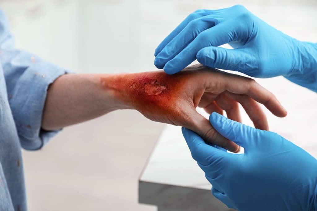 What Does Rehabilitation Look Like for Victims of Severe Burn Injuries ...