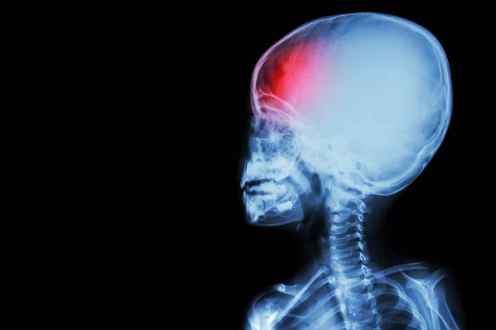 The Ongoing Effects of Severe Pediatric Brain Injury